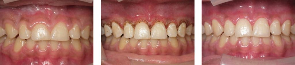 Gingivectomy Diamond Bar CA